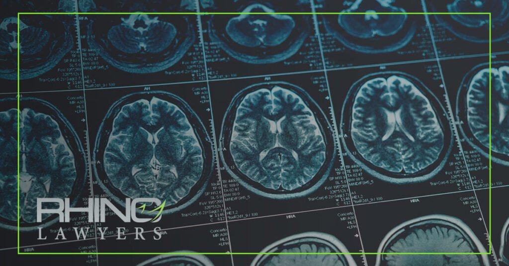What Are Coup and Contrecoup Brain Injuries? | RHINO Lawyers